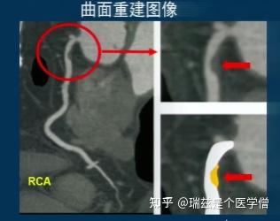 手把手教你读懂冠脉CTA - 知乎