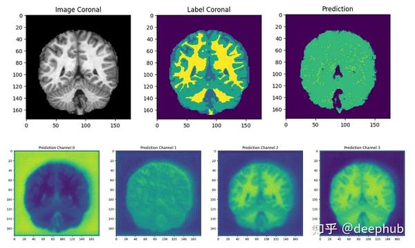 医学图像的深度学习的完整代码示例：使用Pytorch对MRI脑扫描的图像进行分割 - 知乎