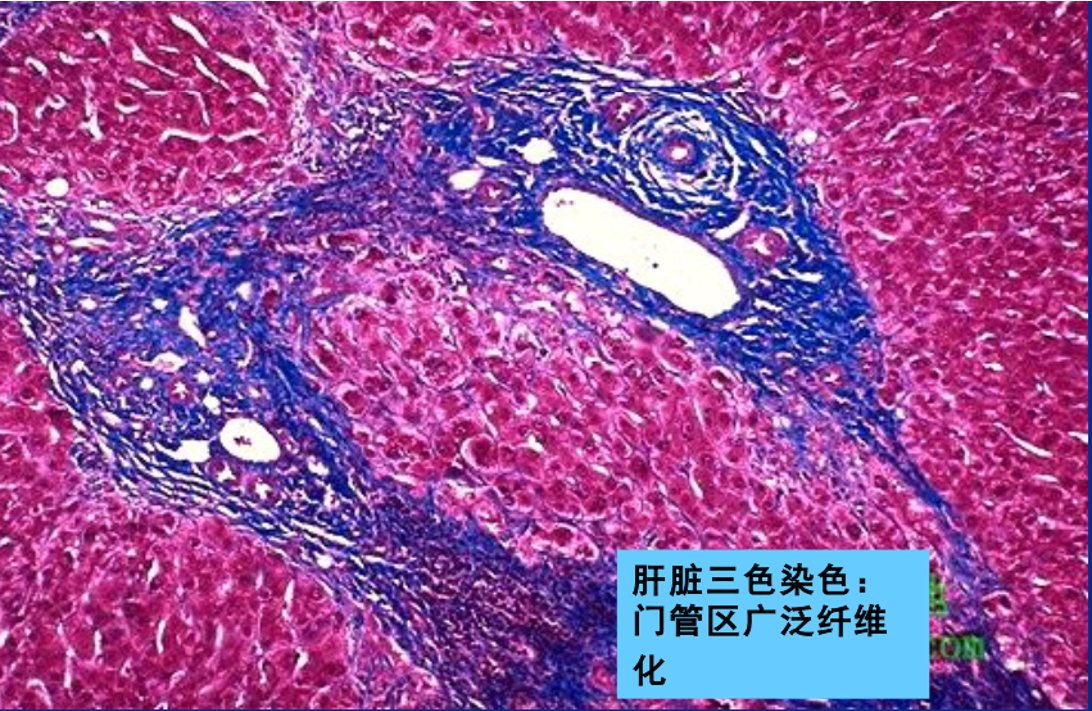 消化病理学：病毒性肝炎-其二 - 知乎