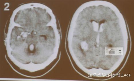 蛛网膜下腔出血诊治指南-2019新版解读 - 知乎