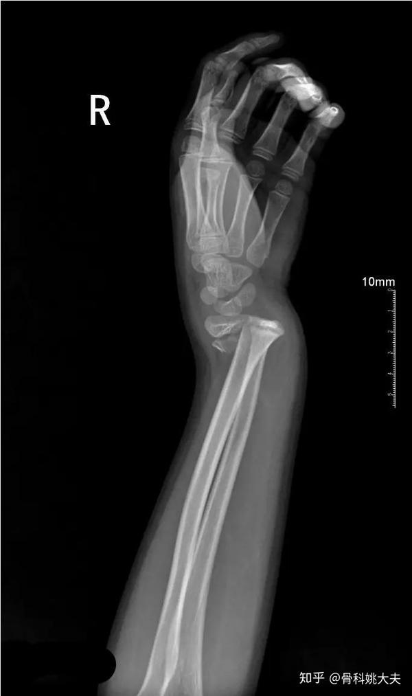 勇敢的二蛋把手给摔断了却一声不吭，全靠医生妙手回春·· - 知乎