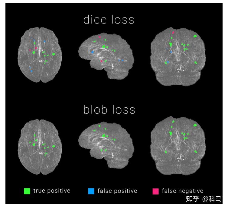 论文笔记 blob loss: instance imbalance aware loss functions for semantic segmentation - 知乎