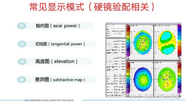 角膜地形图在角膜塑形验配中的解读和应用（文字版） - 知乎