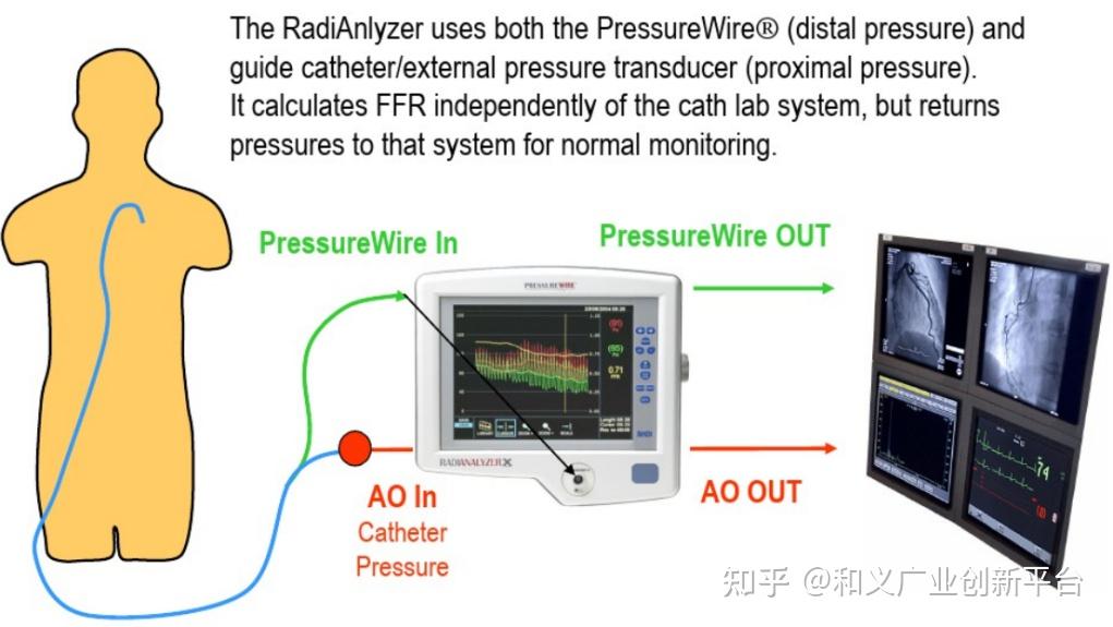 血流储备分数2——一文了解，FFR、FFRct技术原理、特点及应用 - 知乎