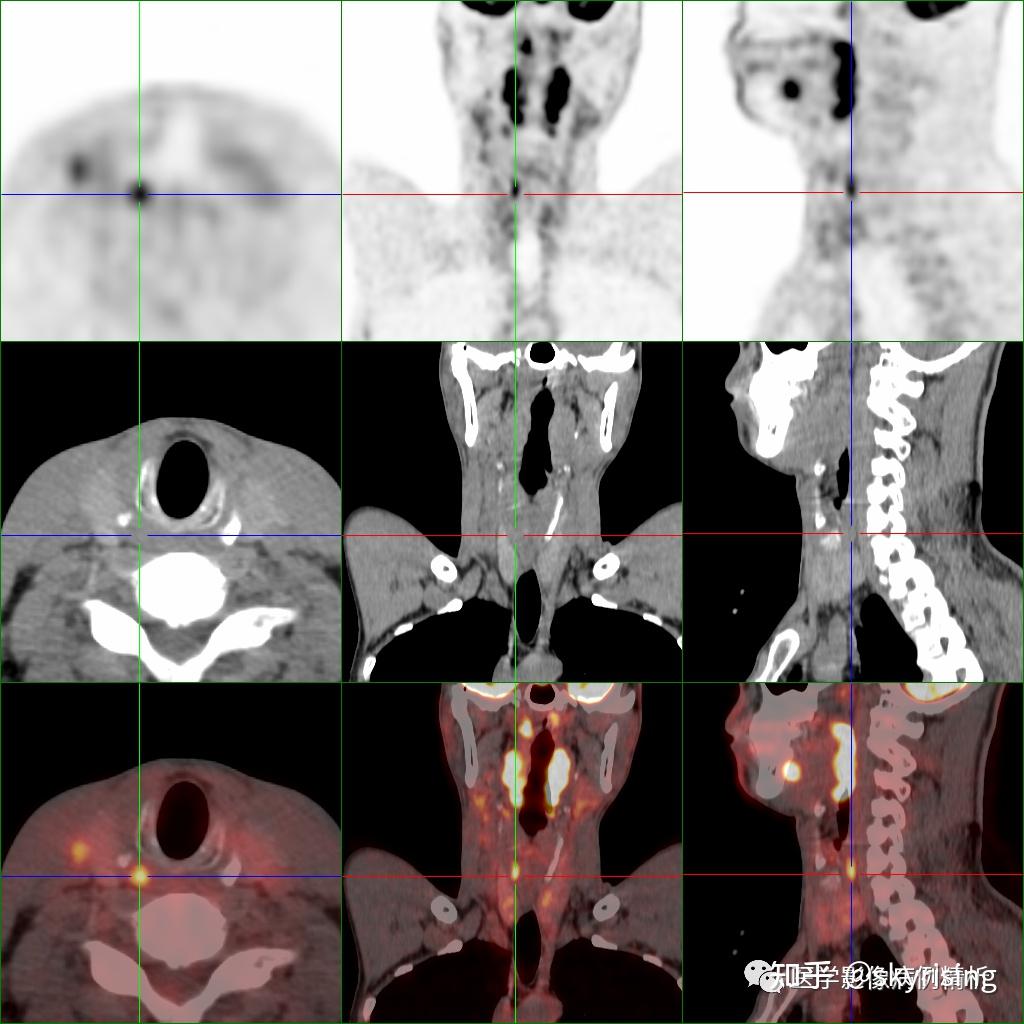 PET/CT+MR多模态检查对于甲状腺病变良恶性鉴别的诊断价值 - 知乎