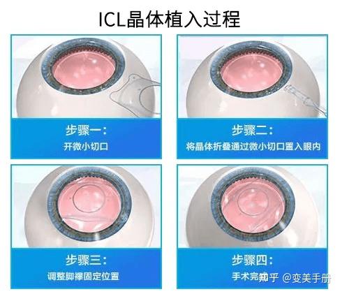 【全国ICL晶体植入近视手术正规机构查询】医院医生资质、口碑、价格、案例自助查询 - 知乎