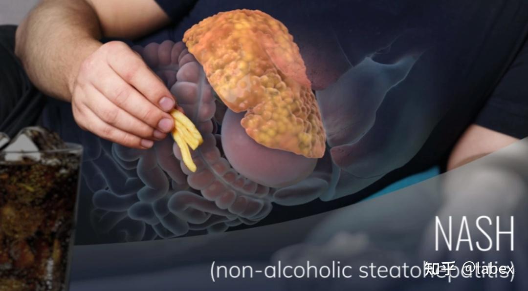 肝病: FGF19靶点 - 非酒精性脂肪肝炎NASH临床2b - 柳叶刀子刊 - 知乎