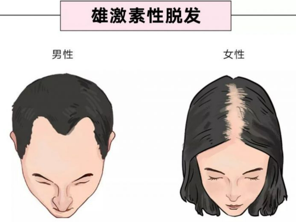 “颜值杀手”--雄激素性脱发 - 知乎