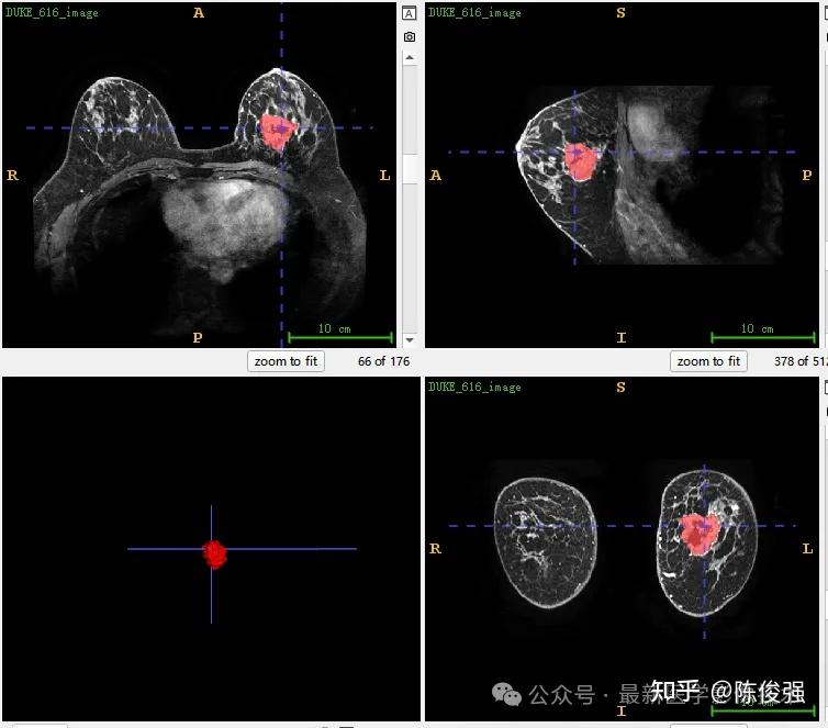 MAMA-MIA2025——乳腺 MRI 肿瘤分割和治疗反应预测 - 知乎