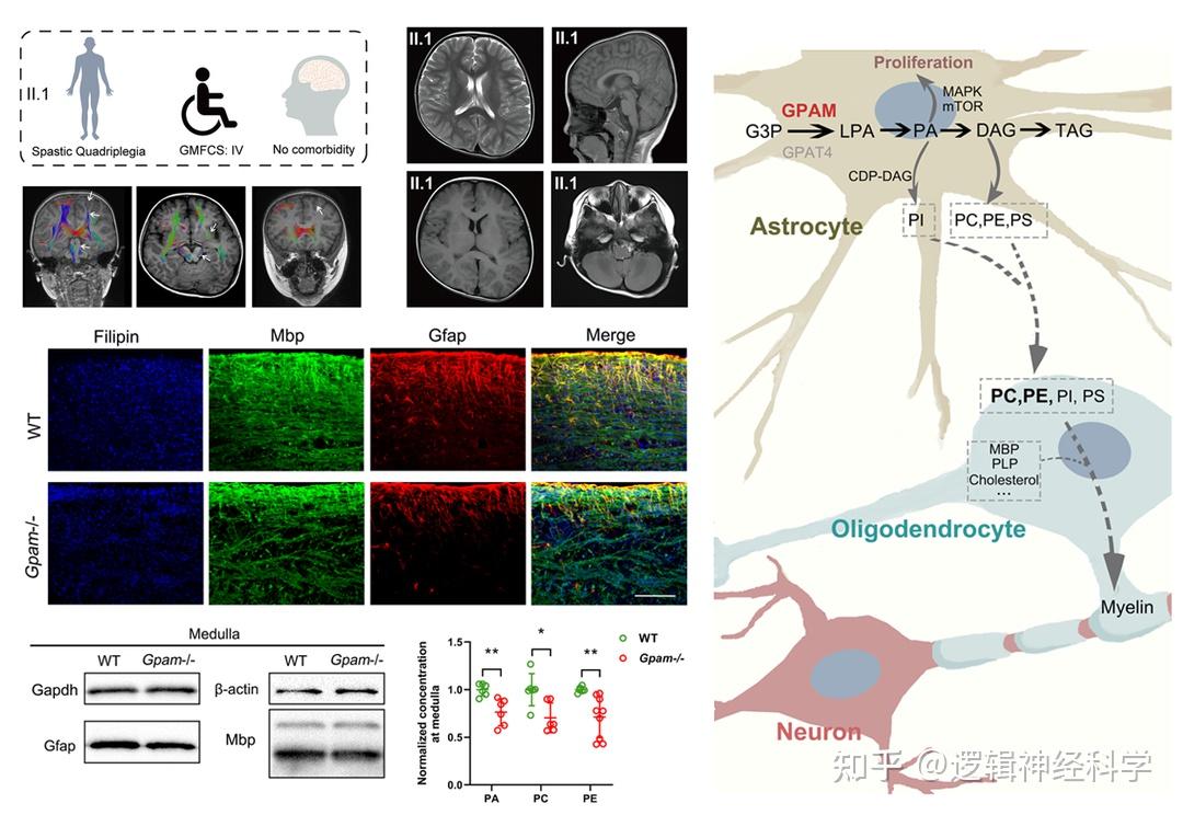 BRAIN长文︱胡昊实验室揭示脑瘫的分子病因, 脑瘫其实是一种遗传病 - 知乎