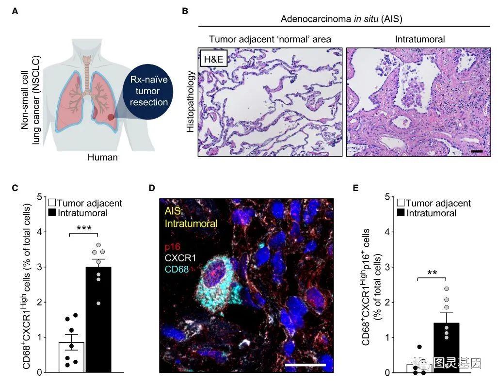 Cancer Cell | 梅奥诊所揭示衰老的肺泡巨噬细胞促进早期肺癌的发生 - 知乎