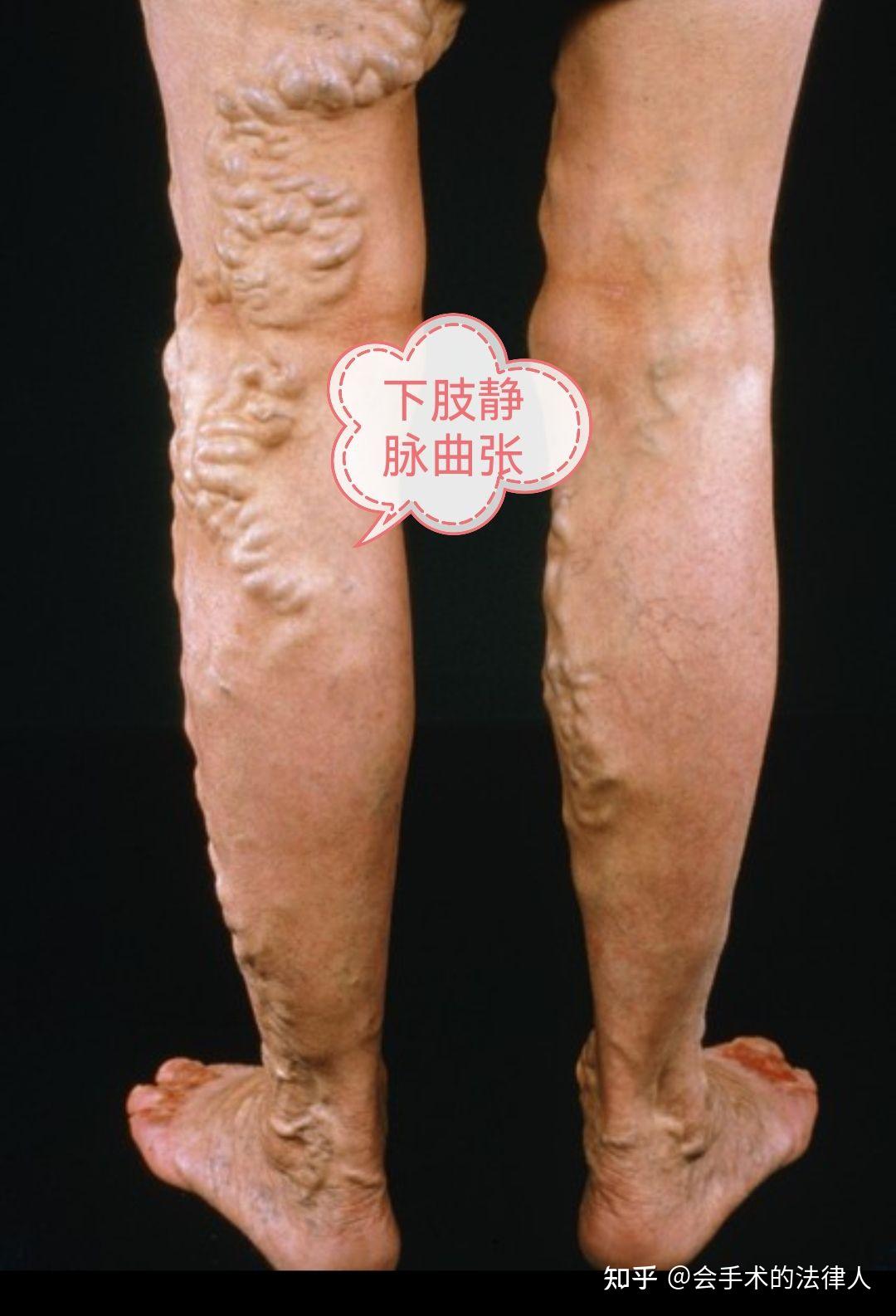 您有痔疮吗？ 知乎 8931