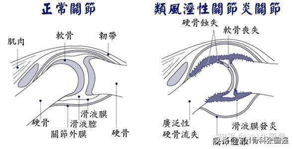 一文读懂八种髋关节疾病！ - 知乎