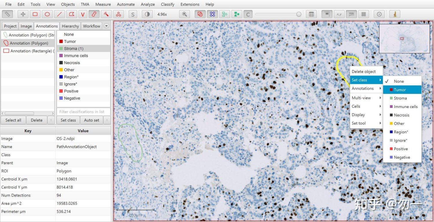 [数字病理]使用QuPath检测IHC阳性肿瘤细胞百分比 - 知乎