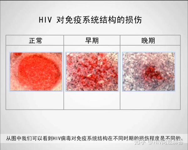 用于抑制 HIV-1 的长效药-CAB+RPV - 知乎