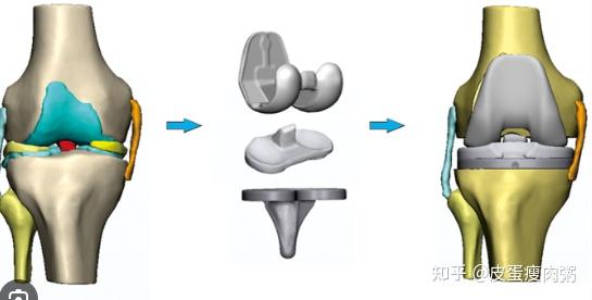 TKA(全膝关节置换术） - 知乎