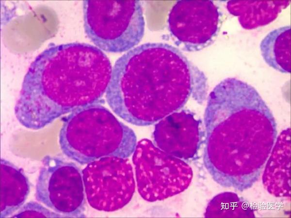 急性单核细胞白血病分型，你真的清楚吗？ - 知乎