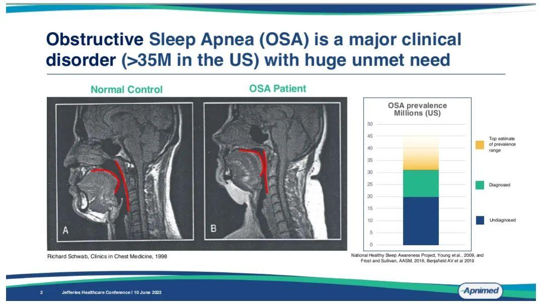 打呼噜有救了！潜在全球首个口服疗法临床3期试验即将启动 - 知乎