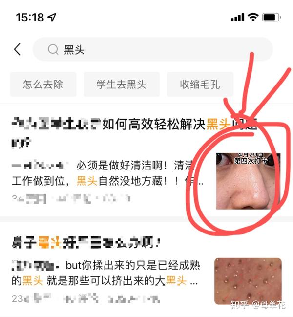 我黑头摸起来一粒一粒的,能挤出来黄黄的条状,用啥能把黑头去掉啊?求推荐 知乎
