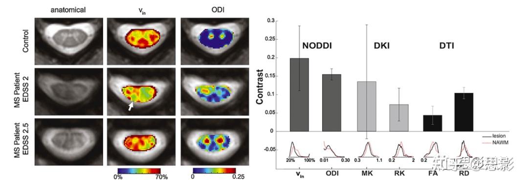 NODDI在临床研究中的应用 - 知乎