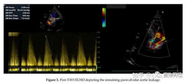 复杂Tavi术后的Savi手术 - 知乎
