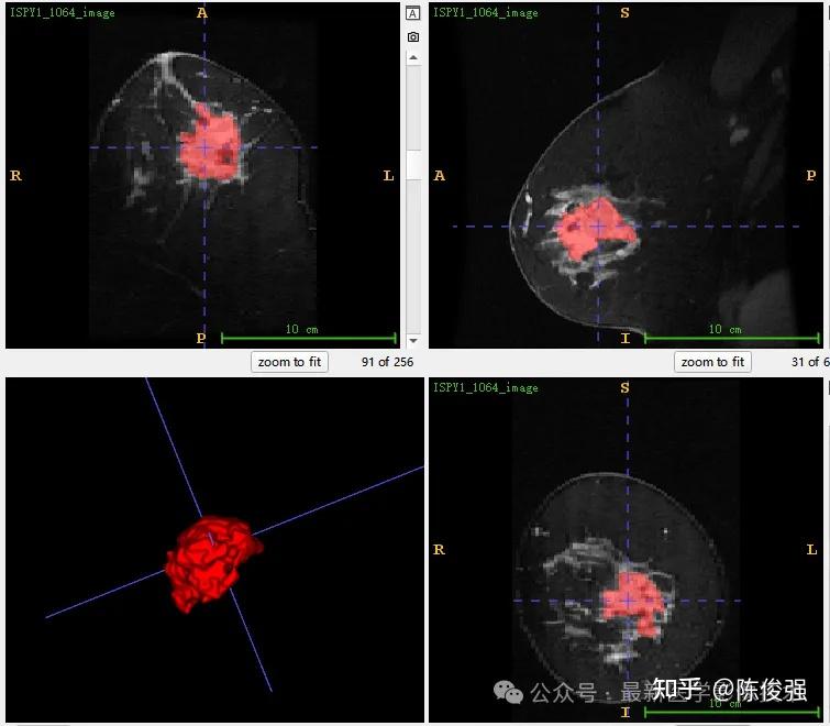 MAMA-MIA2025——乳腺 MRI 肿瘤分割和治疗反应预测 - 知乎