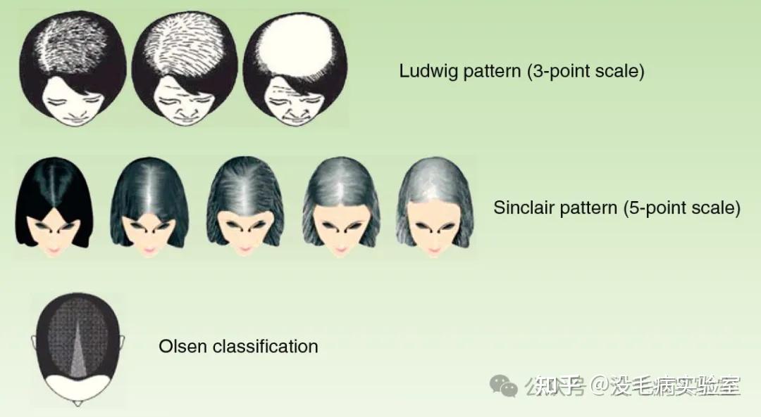 最新|临床皮肤科杂志2024：中国雄激素性秃发诊疗指南 - 知乎
