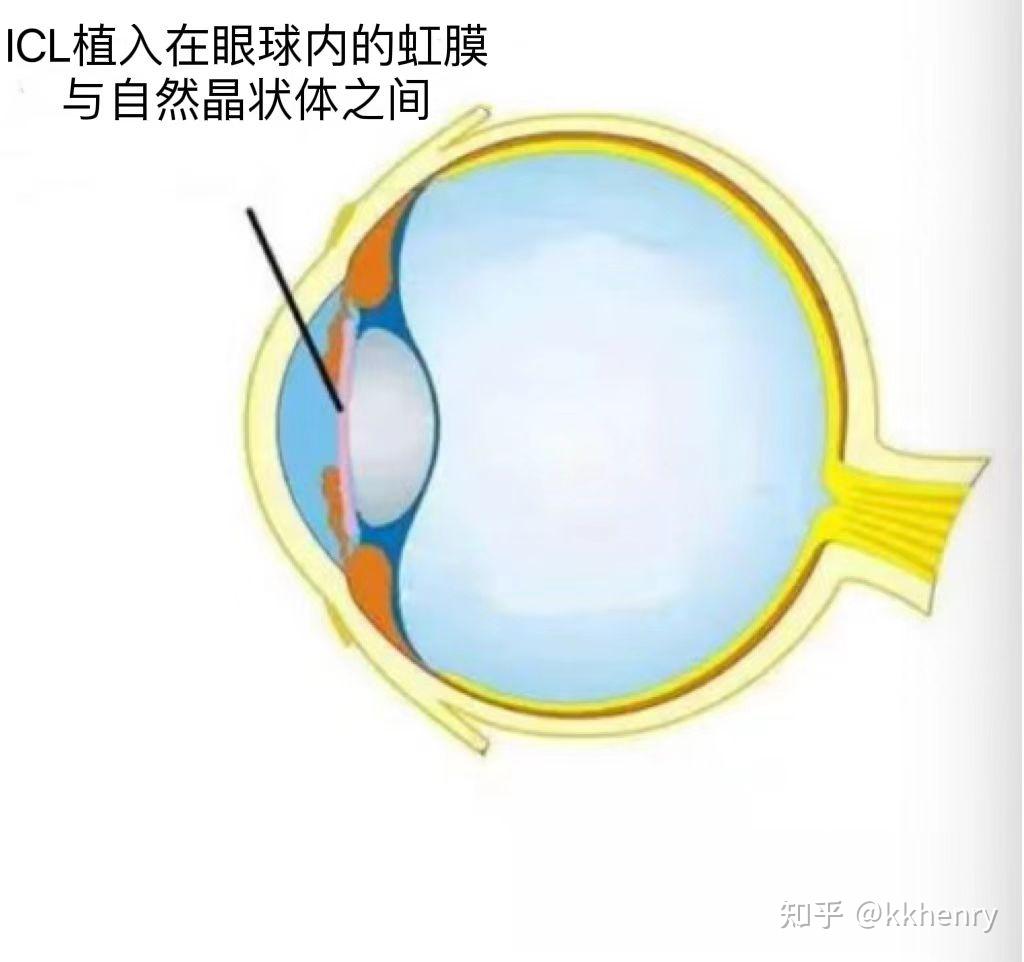 矫正视力黑科技——ICL可植入式Collamer晶体 - 知乎