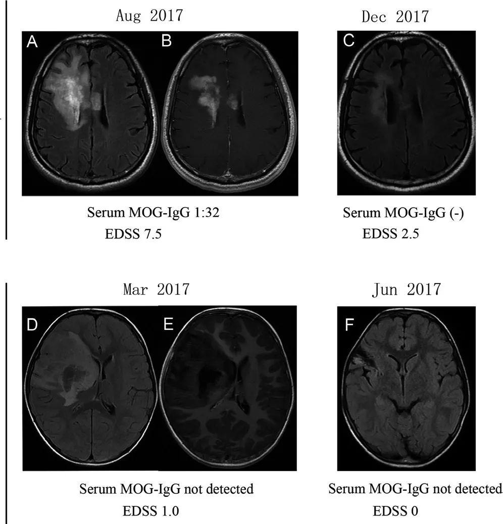 难倒大部分神内医生的MOG抗体病，8大临床表型一文掌握 - 知乎