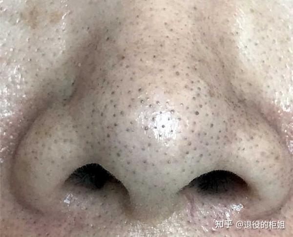 黑头的本质是什么?如何区别黑头? 知乎