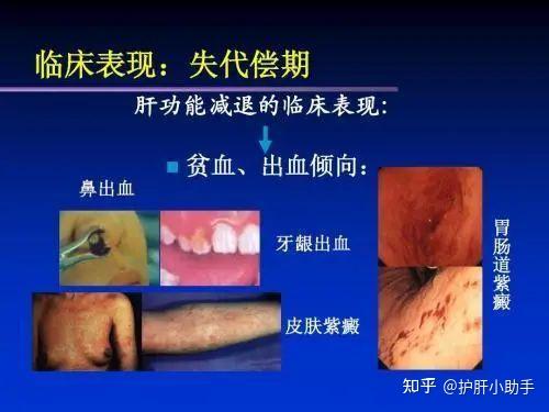 肝硬化分为代偿期和失代偿期，区别表现在五个方面 知乎