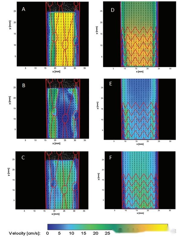 科廷大学医学院的Chong等人采用粒子图像测速（PIV）实验比较AFX支架和主动脉分叉覆膜支架（CERAB）的血流动力学 - 知乎