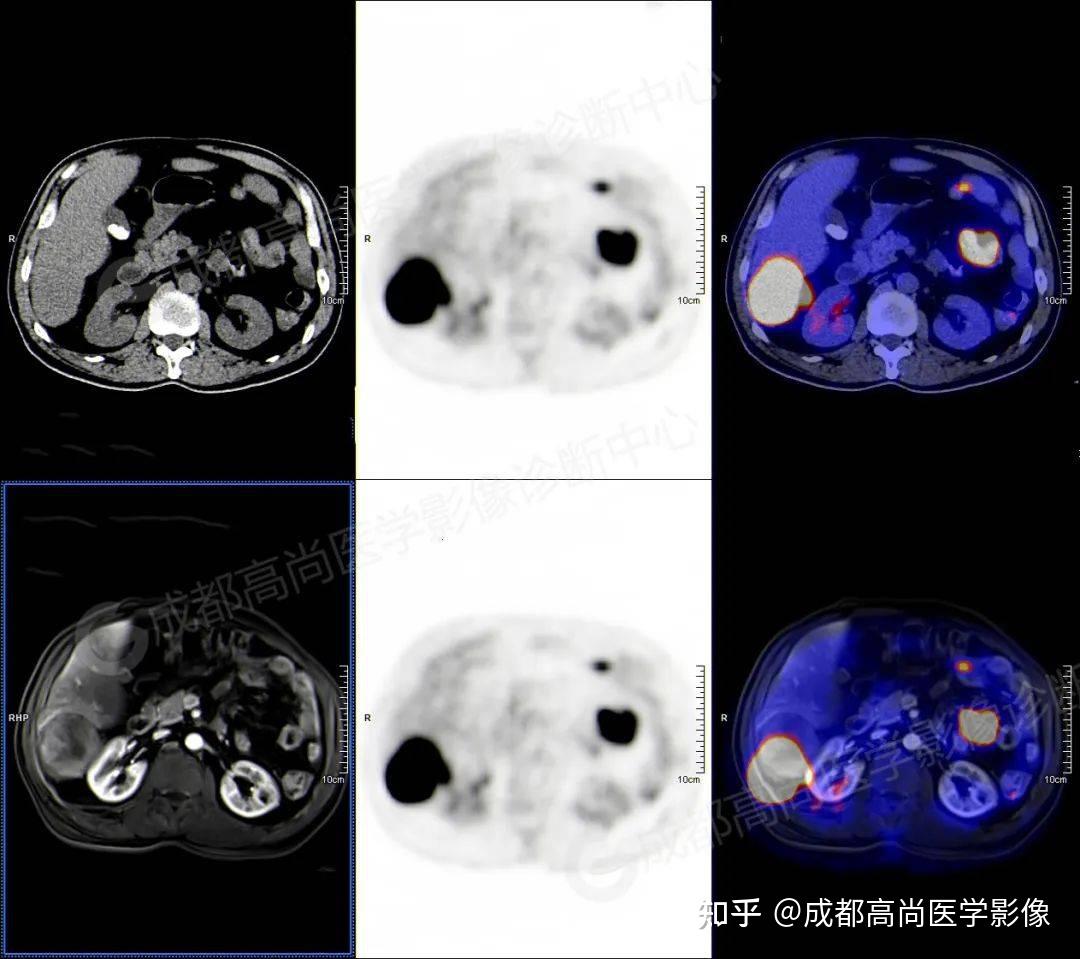 【高尚病例】PET-CT/MRI多模态检查实现“一站式”诊断 - 知乎