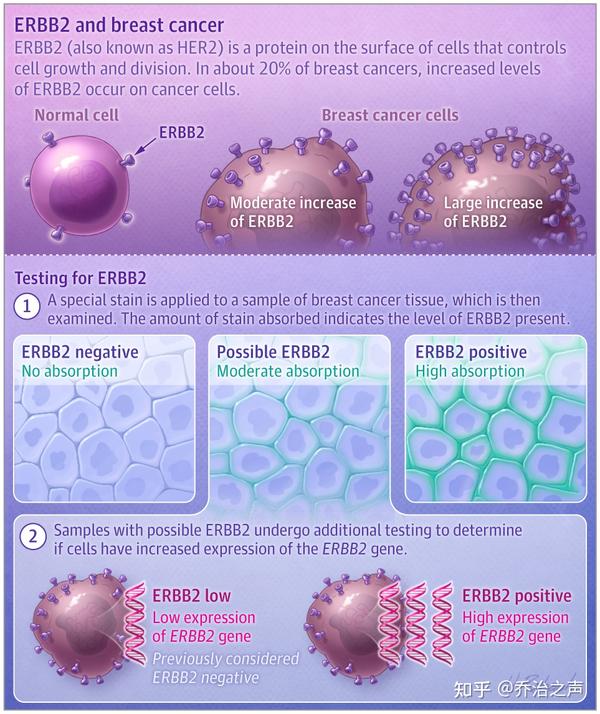 【肿瘤前沿大家说】HER2-低表达乳腺癌诊断的临床应用 - 知乎