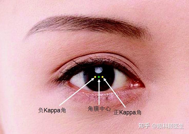 什么是Kappa角？这个角在眼科有什么意义？ - 知乎
