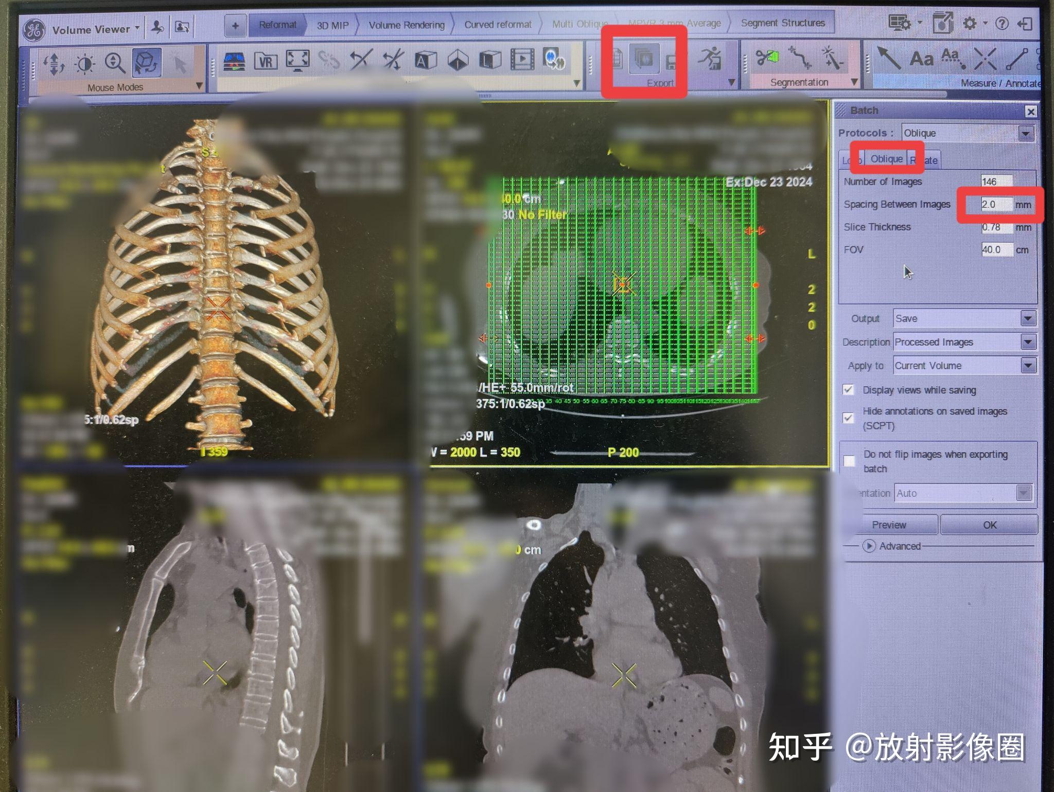 浅谈CT三维重建的操作方法 - 知乎