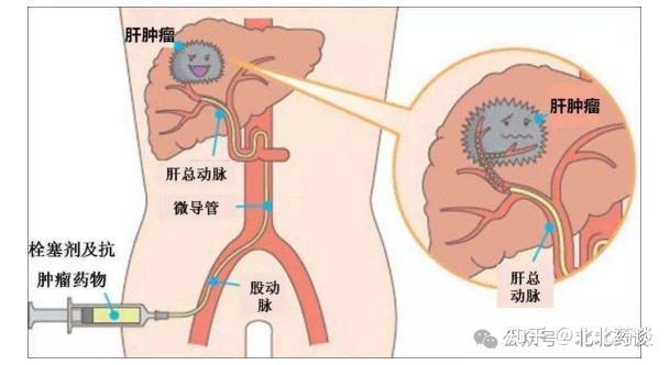 肝癌治疗中的HAIC、TACE，如何选择，优缺点各是啥？ - 知乎