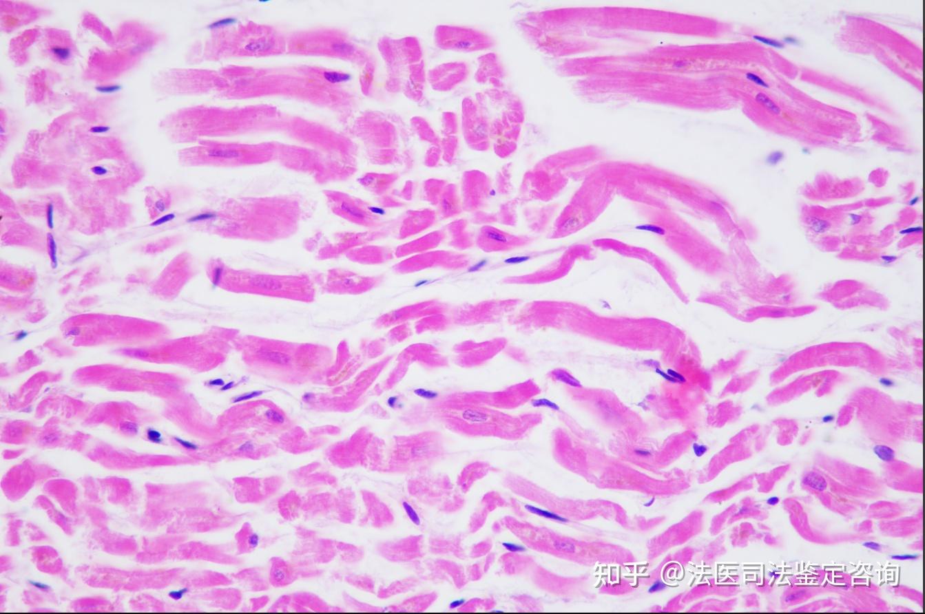 法医组织病理学——心肌梗死 - 知乎