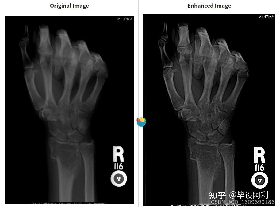 医学图像处理-X射线图像增强 -对比度限制自适应直方图均衡化（CLAHE）、非锐化掩模（UM）和高频强调滤波（HEF） - 知乎