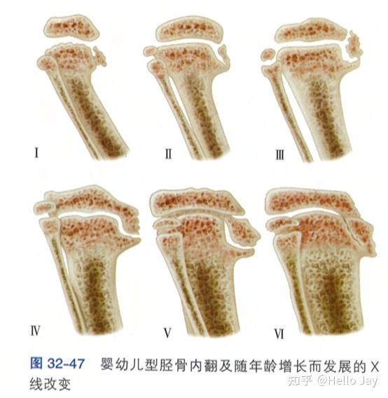 胫骨内翻（Blount病） - 知乎