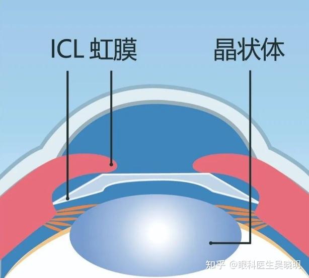 ICL晶体植入术前检查之UBM，为什么术前要做UBM检查？ - 知乎