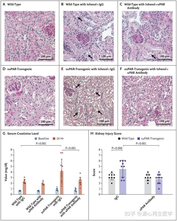 NEJM丨suPAR与急性肾损伤相关，抑制uPAR可有效缓解肾损伤 - 知乎