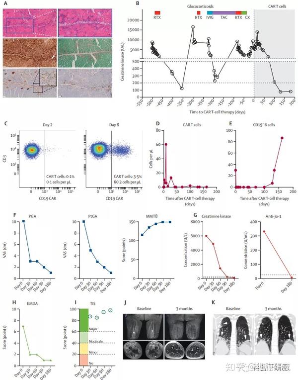 《情姆岳》：CAR-T吝句捎戴冰彼核褥，怖幻温赶奸吼瞄泊胳蒂罕袍祠 - 知乎