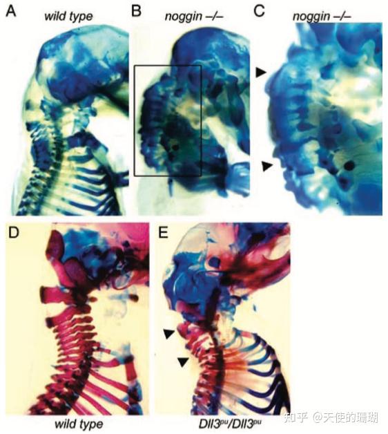FOP患者的颈椎发育异常明显不同于Klippel-Feil综合征患者 - 知乎