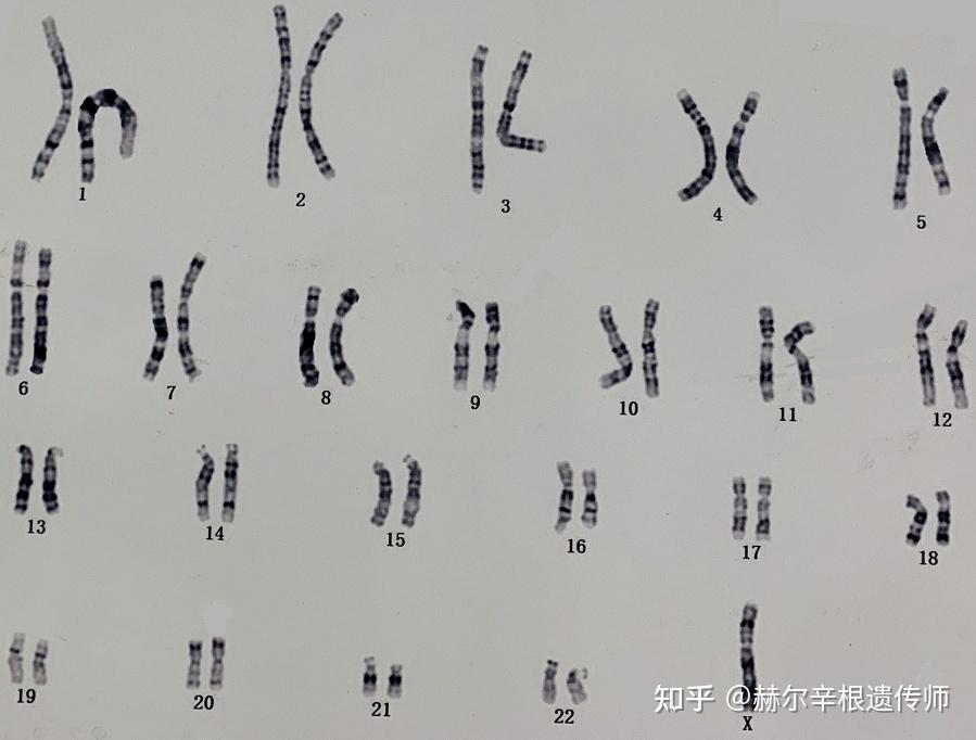 少条X或Y染色体怎么办？（45,X综合征/特纳综合征/Turner 综合征） - 知乎