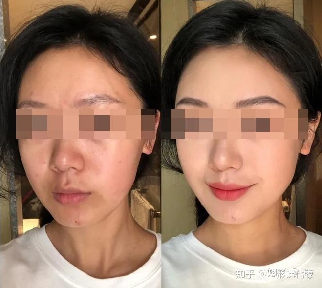 垮脸必看!你做的超声炮为什么没效果? 知乎
