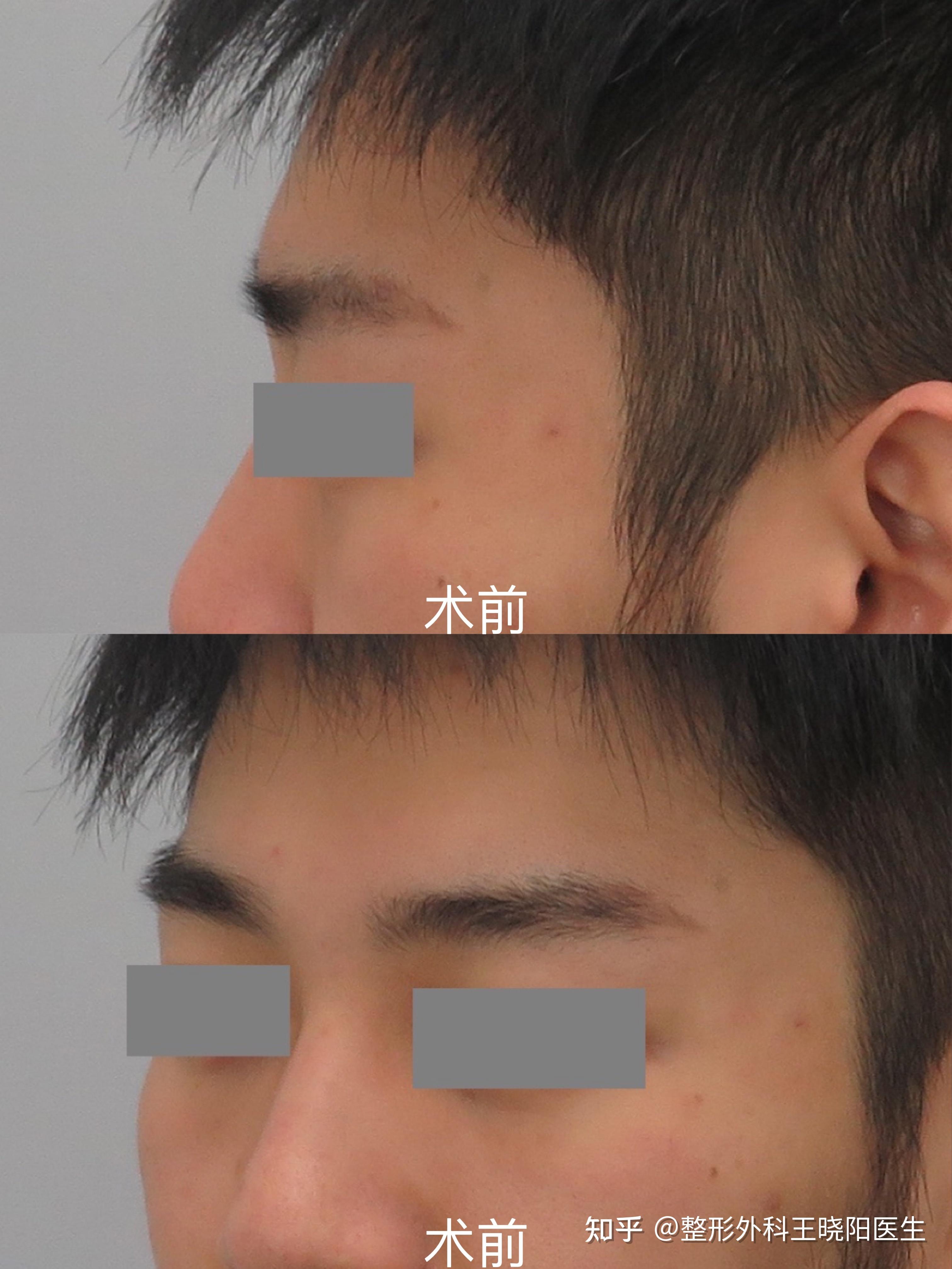 爱缇恩mADM面部皮下浅层平铺注射追踪观察 - 知乎