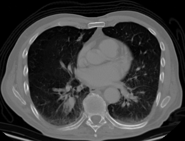 Chest CT-Scan images 数据集介绍 - 知乎