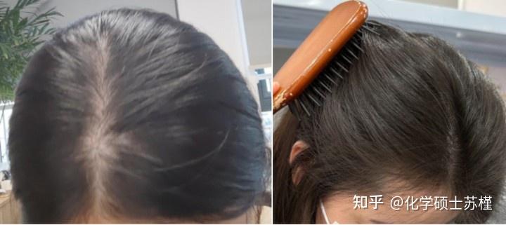 【哈恩咖啡因洗发水】控油去屑的效果真的很猛吗？男女款都买来了，来给大家测评看看是不是真的好用