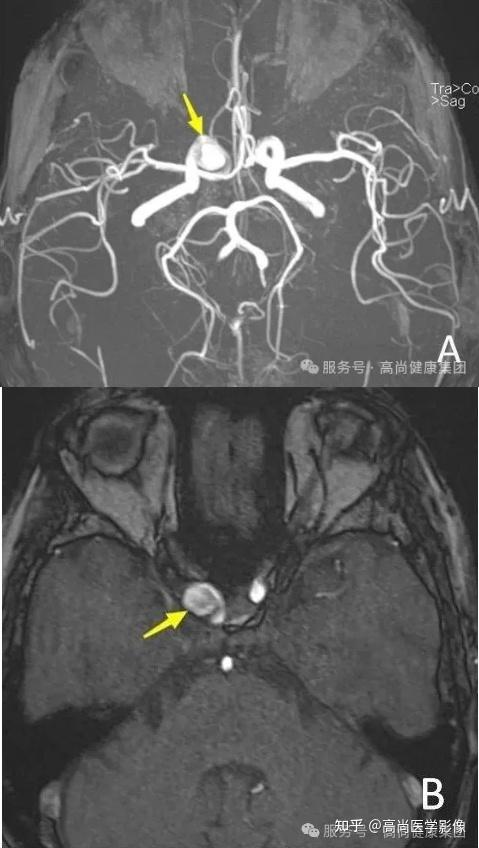 高分辨磁共振血管壁成像（HRMR-VWI）-学术荟萃系列专题 - 知乎